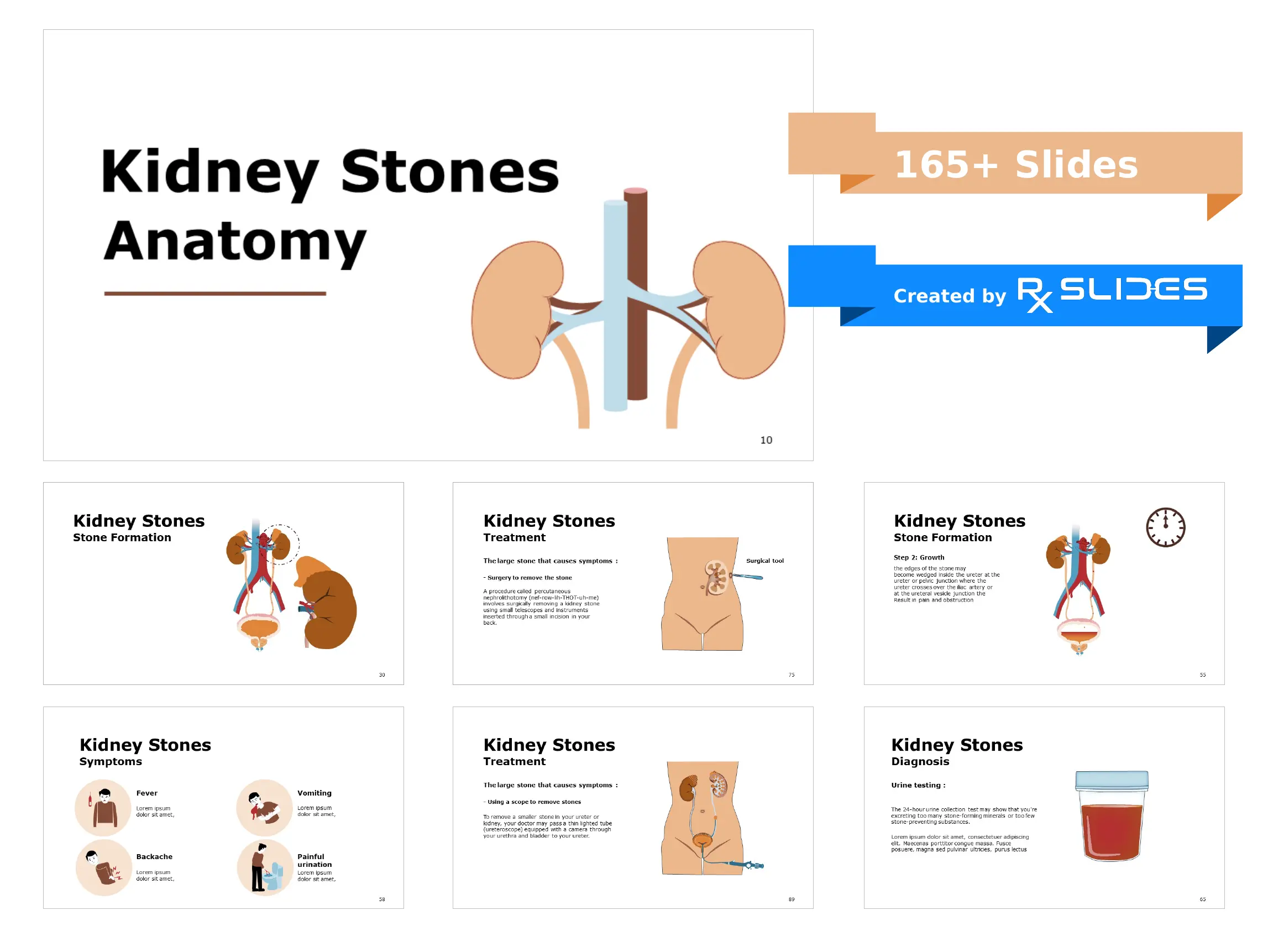 Download kidney Stones PowerPoint Template|RxSlides
